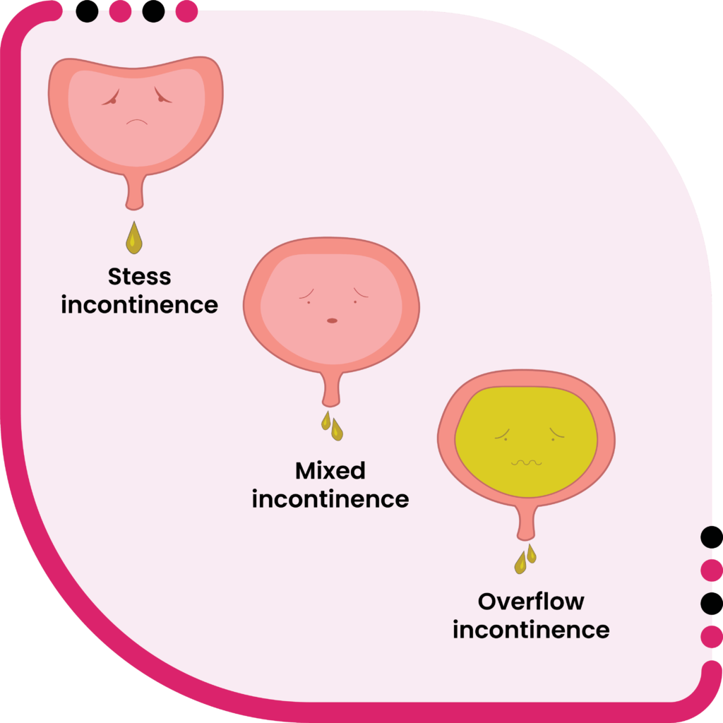 Urge Incontinence Treatment in Jalandhar - Star Cosmetic
