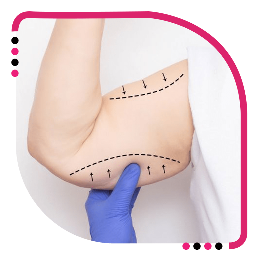 Arm Lift Surgery in Jalandhar | Brachioplasty Surgery In Jalandhar